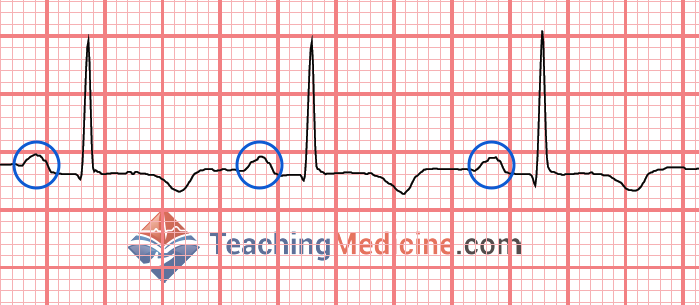 Upright P Waves